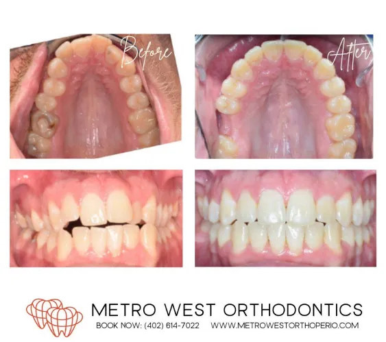 Maxillary Skeletal Expander(MARPE/MSE) | Orthodontist & Periodontist in ...